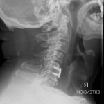 Anterior Cervical Discectomy & Fusion (ACDF) - Melbourne Orthopaedic Group