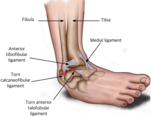 Ankle Instability - Melbourne Orthopaedic Group