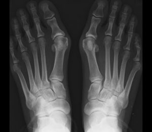 Hallux Valgus (Bunions) - Melbourne Orthopaedic Group