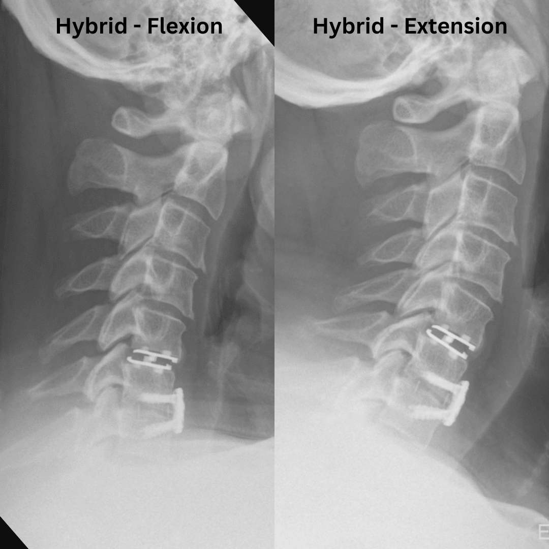 Hybrid ACDF & Cervical Disc Replacement (CDR) - Melbourne Orthopaedic Group