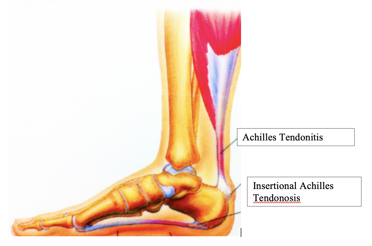 Achilles Tendonitis - Melbourne Orthopaedic Group