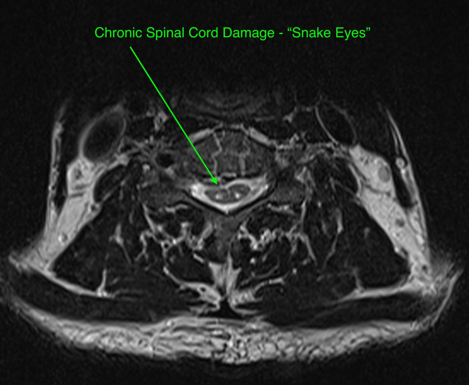 Cervical Myelopathy - Melbourne Orthopaedic Group